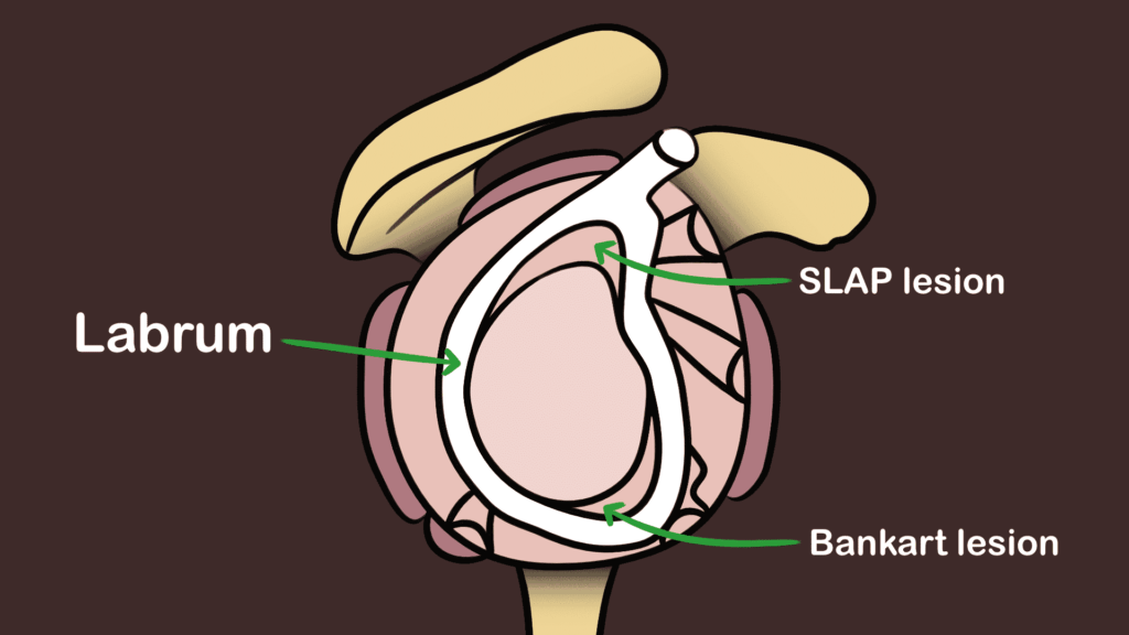 Recurrent Shoulder Dislocation Repair - Dr. Ishan Shevate